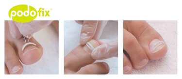 Podofix adhesive brace - IMGRO Beauty